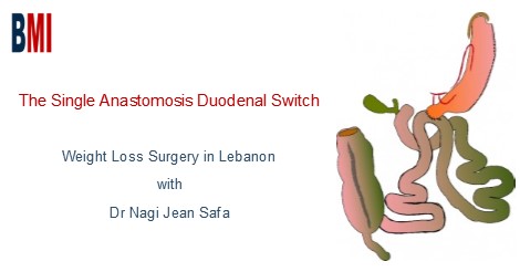 Dr Nagi Jean Safa - Single Anastomosis Duodenal Switch in Lebanon - SADIS
